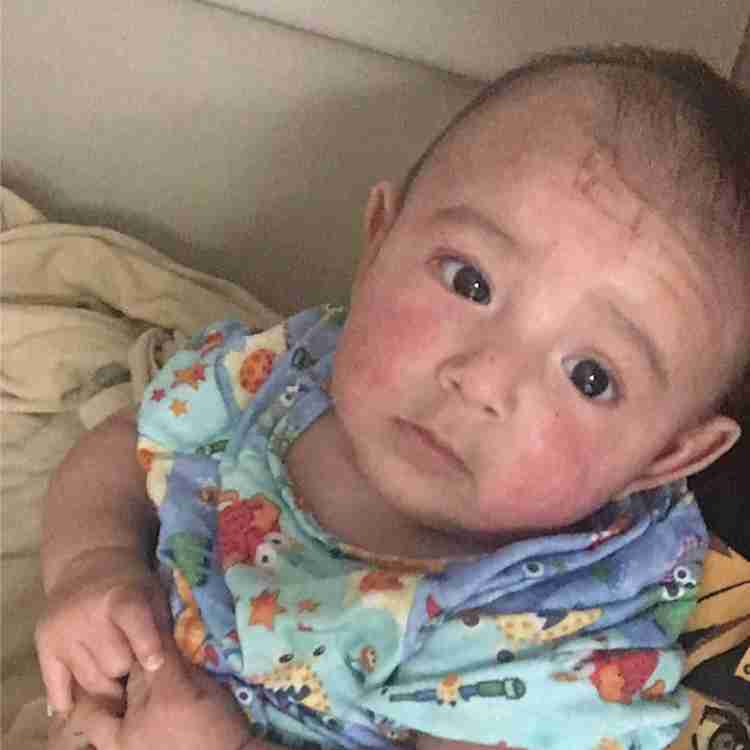 Dravet Stories - Dravet Syndrome Foundation